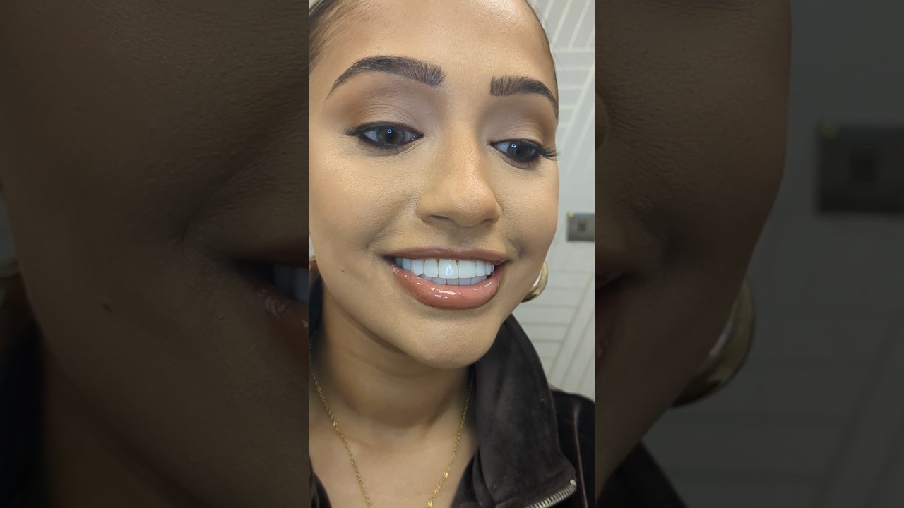 Before and after a full set of composite veneers #veneers #newsmile #teethwhitening #howto #hack