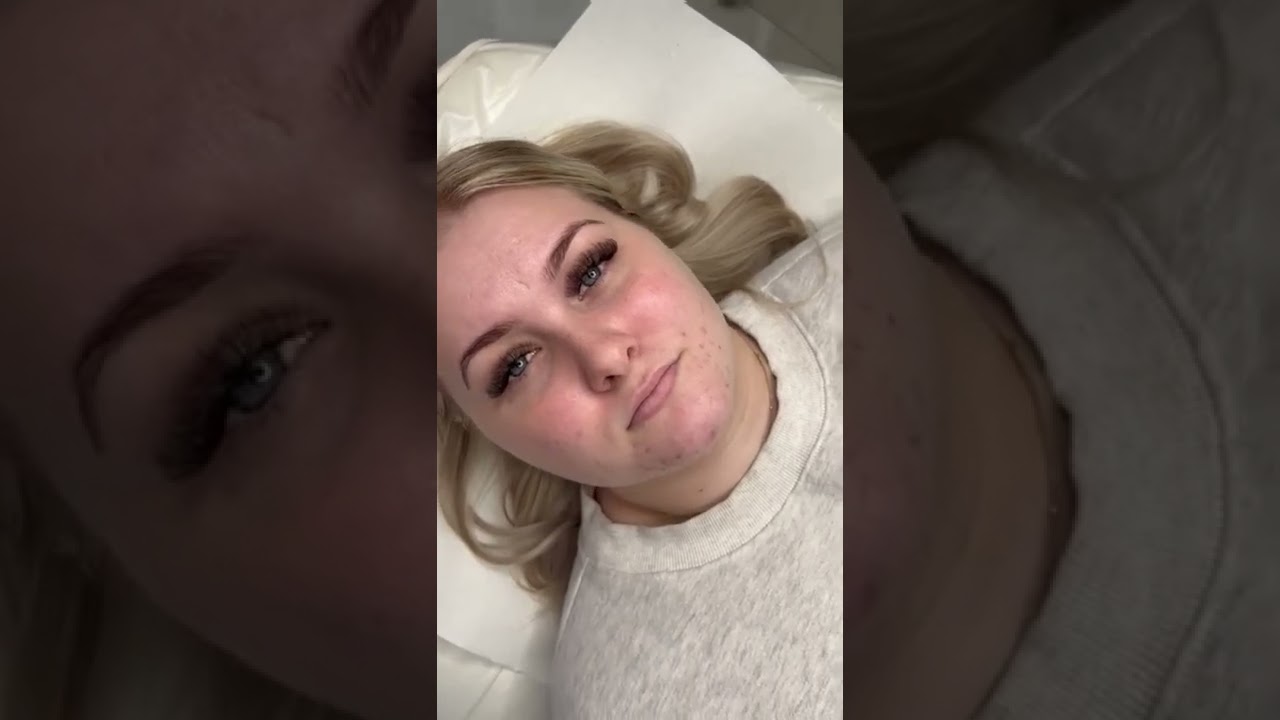 Lip Fillers Before & After: Lip Building with thin Lips