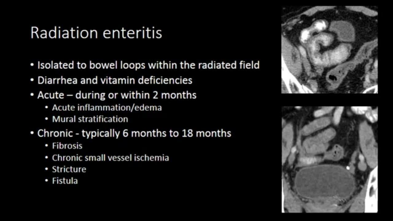 CT MR evaluation of Crohn's disease