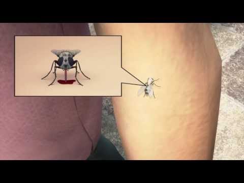 Horsefly bite symptoms