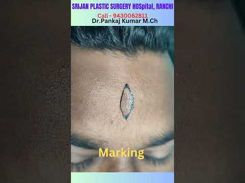 scar revision surgery in Ranchi| Scar treatment| #shorts # youtubeshorts