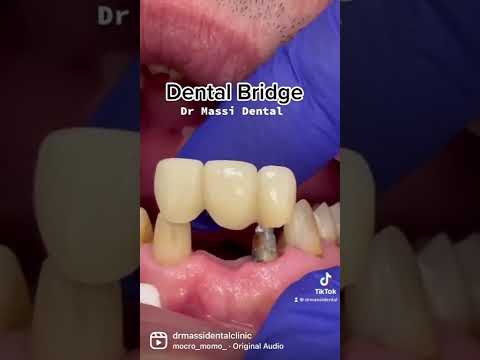 Dental Bridge on front teeth, root canal treated teeth ! #video #trending #fyp #viral #tiktok#shorts