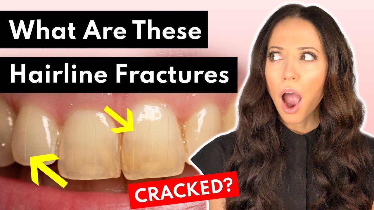 What are CRAZE LINES on Teeth & What to Do About Them