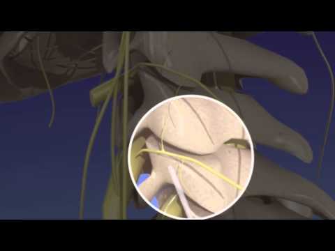 Cervical Facet Radiofrequency Neurotomy - Neck