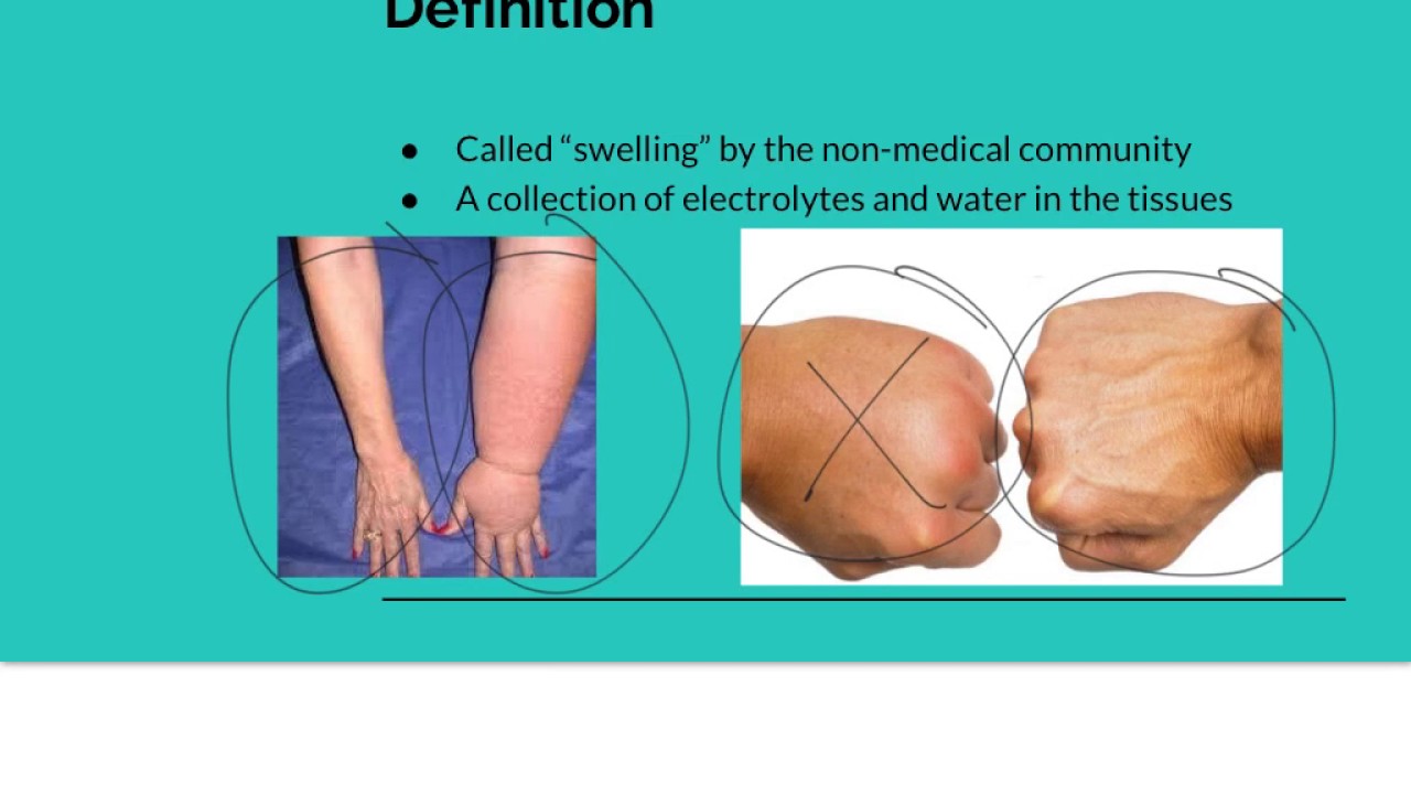 edema test ppt movie.mp4