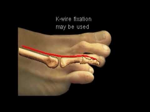End to End (Mild to moderate hammertoe correction surgery)