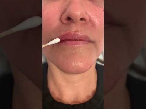 Lip Flip Before and After with Juvederm Ultra Filler.