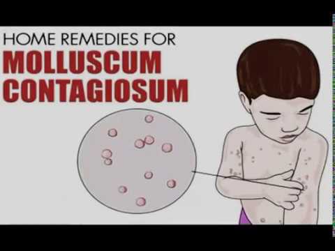 Powerful Remedies To Tackle Molluscum Contagiosum At Home Home