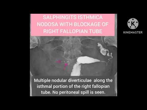 Salpingitis Isthmica Nodosa (OBS/gynae)