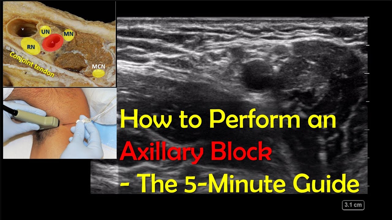 Axillary Block – A 