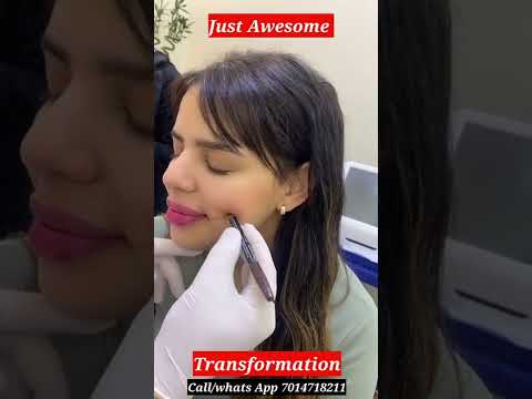 Amazing Dimple Creation Treatment #shorts