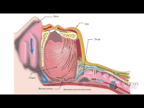 Different Types of Sleep Apnea, With Dr Larry Pribyl, Center for TMJ & Sleep Apnea
