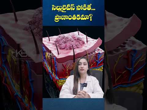 When Cellulitis Gets Infected? How Serious It Can Be? | KBK Hospitals