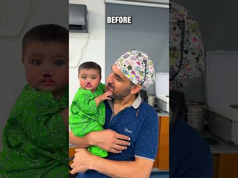 ✨Free Cleft Lip & Palate Surgery👄✨Before | After Result🤩🥰Dr. Habib's clinic👨🏻⚕️🏥