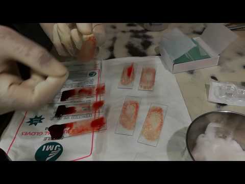 How to make bone marrow aspiration smear without the need for EDTA ...