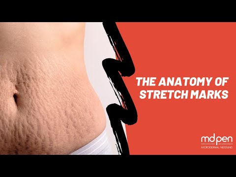 The Anatomy of Stretch Marks