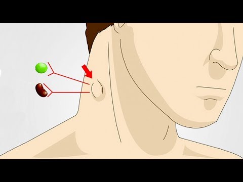 BUKOL sa LEEG (Kulani) - ni Doc Gim Dimaguila #6b (Ear Nose Throat Doctor)