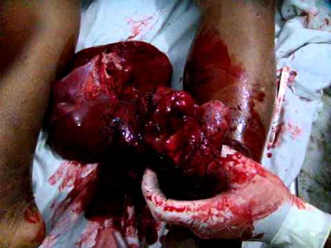 Demonstration of increased vascular permeability in the lungs and liver.MPG