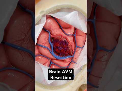 AVM: Bleeding in your brain (3D Animation)