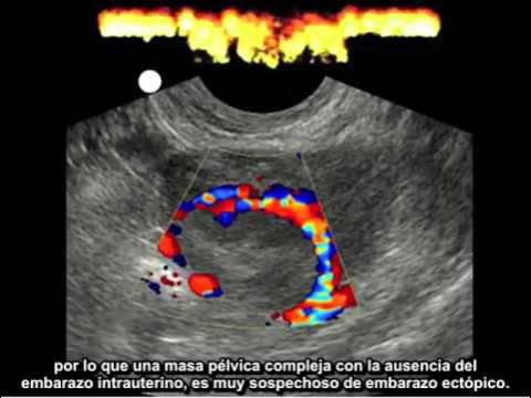 How To: Ectopic Pregnancy Part 2 Spanish Case Study Video