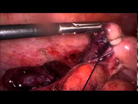 Laparoscopic appendectomy for perforated Acute appendicitis