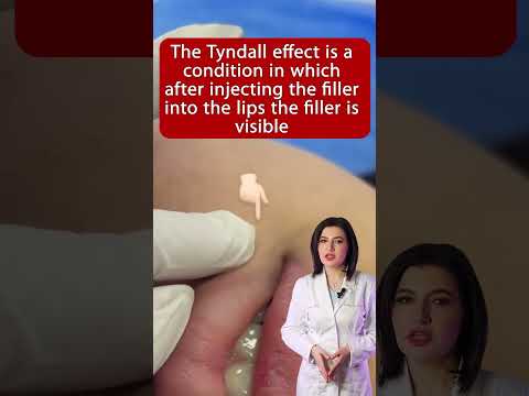Lip Filler Gone Wrong. Tyndall Effect