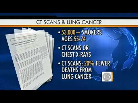 CAT scan lung cancer screenings cut deaths: study