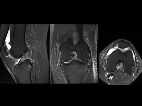 Knee MRI : Medial collateral ligament injury