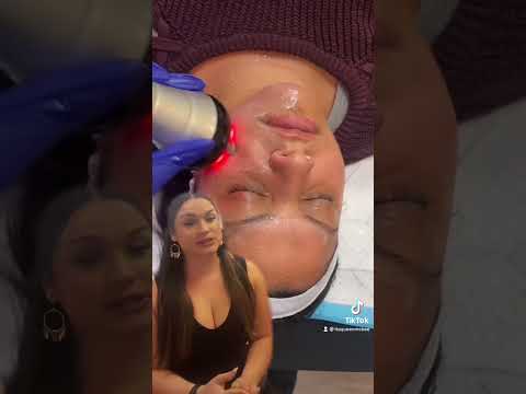 What is an RF facial? #RFfacial