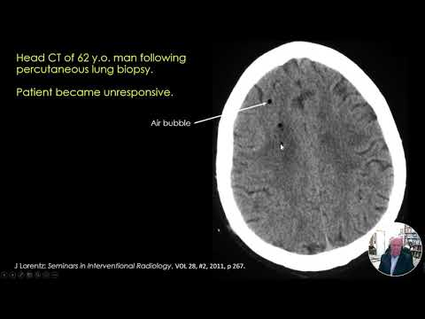 Air Embolism Risk Factors, Detection, and Intervention Presentation