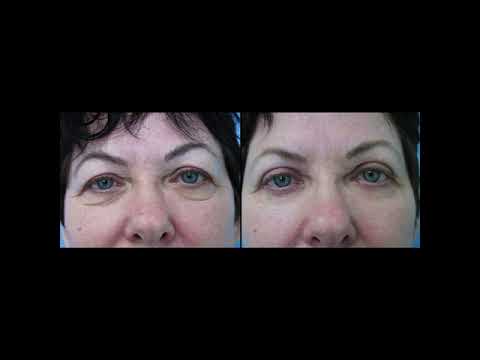 Dr. Joseph J Castellano | Before & After Video: Eyelid Surgery Case #121
