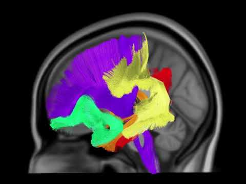 Major white matter pathways of the brain