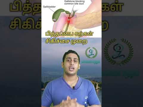 பித்தப்பை கற்கள் சிகிச்சை முறை| Gall stones treatment methods| Gall bladder removal surgery - part 3