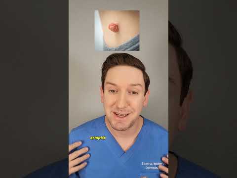 Dermatologist explains SKIN TAGS: What are they? Do they need to be removed? #skintags #derm
