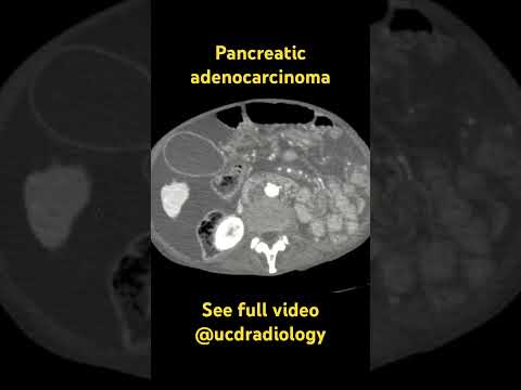 Pancreatic adenocarcinoma #radiologist #radiology #doctor #medicine #radiologyresident