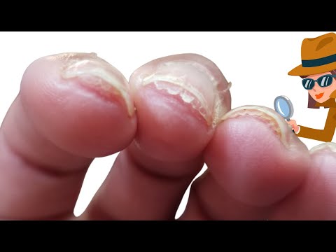 Why is the nail separating from nail bed? [Nail bed hyperkeratosis?]