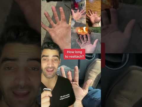Finger Amputation and Replantation