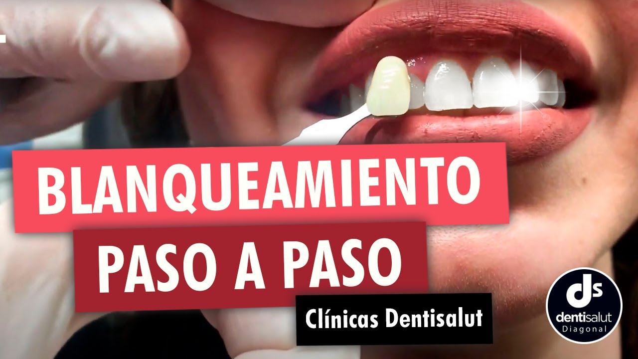 🦷😁 Blanqueamiento dental PASO A PASO 😁🦷 Antes y después - Clínica Dental Dentisalut