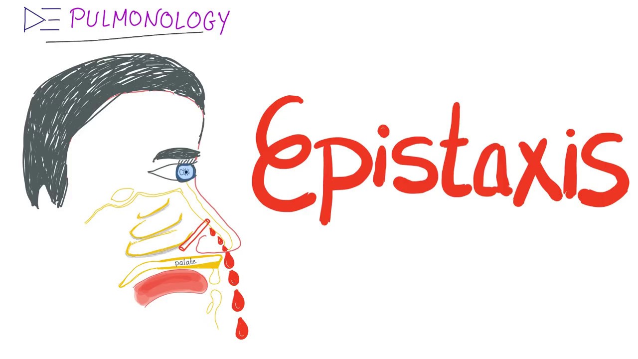Epistaxis (nosebleed) - Causes and Treatment