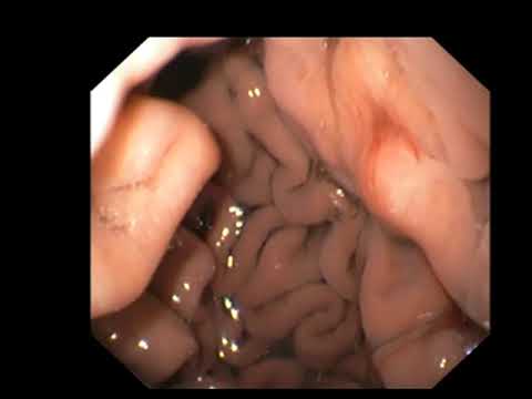Hypertrophied gastric folds
