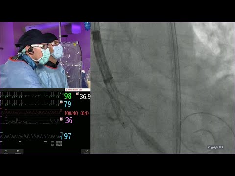 Expanding horizons for patients with long life expectancy with the Evolut FX + TAVI system