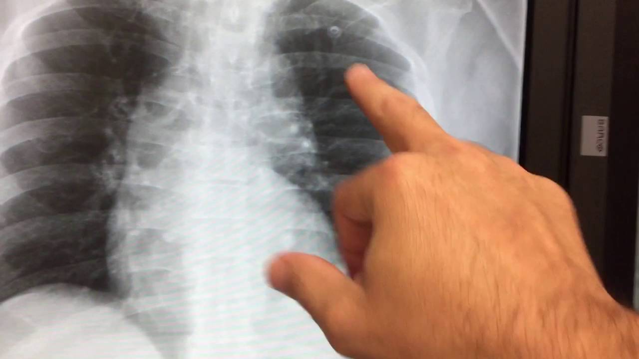 How to find those rib fractures on a Chest X-Ray