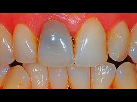 Why Is My Tooth Blue? [Comprehensive Answer] - CGAA.org