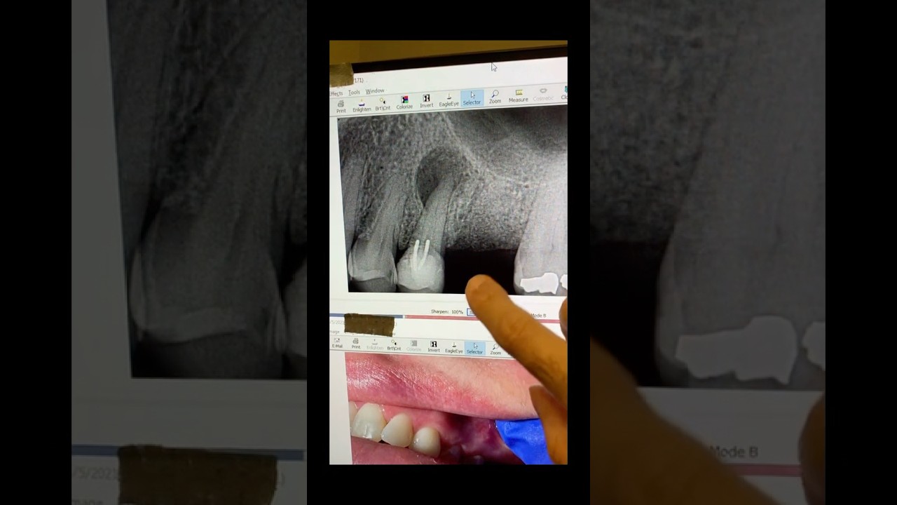 No cbct. #dentists #dentalartistry #dentalcare #rootcanaltherapy