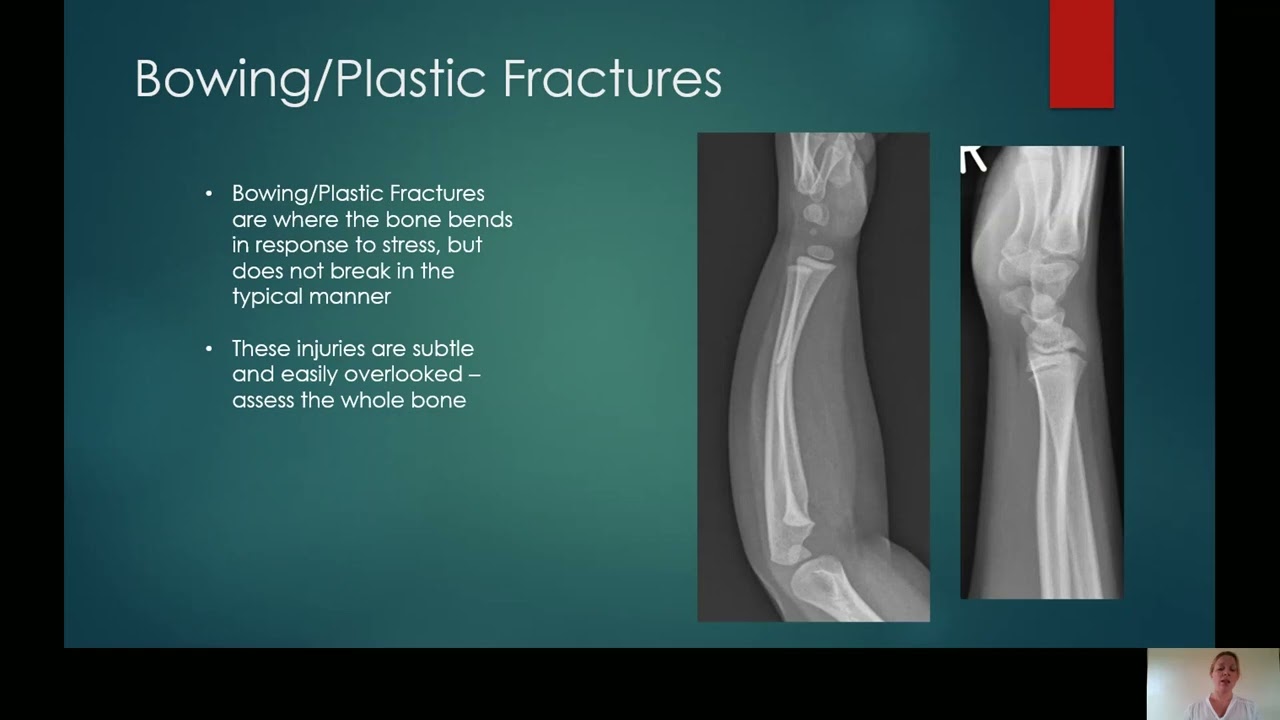 Paediatric fracture x-ray interpretation - an overview