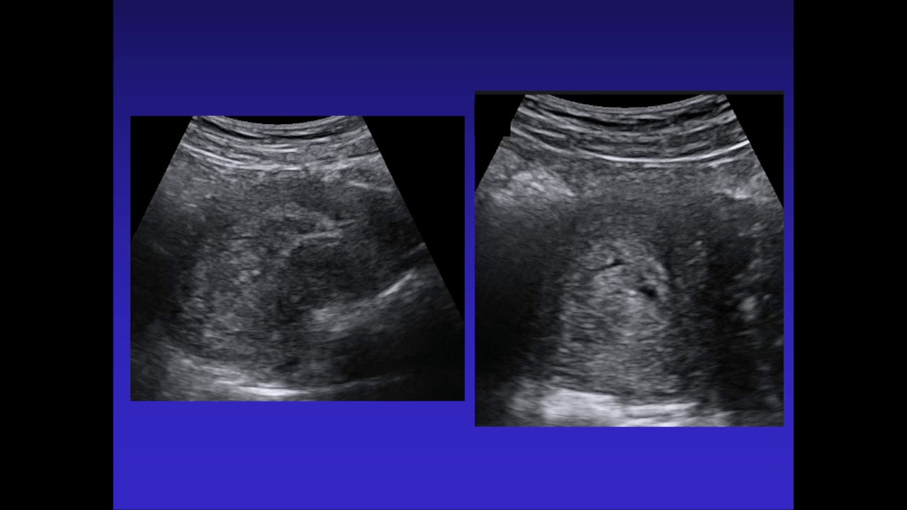 SonoWorld: Retained Products of Conception