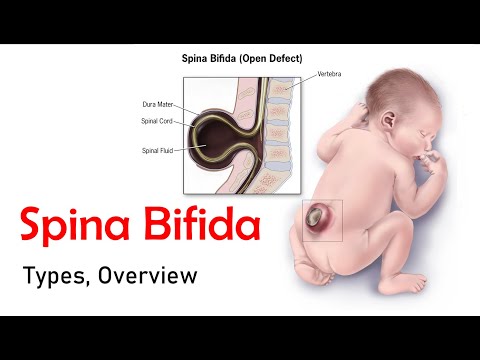 spina bifida overview (types and summary)