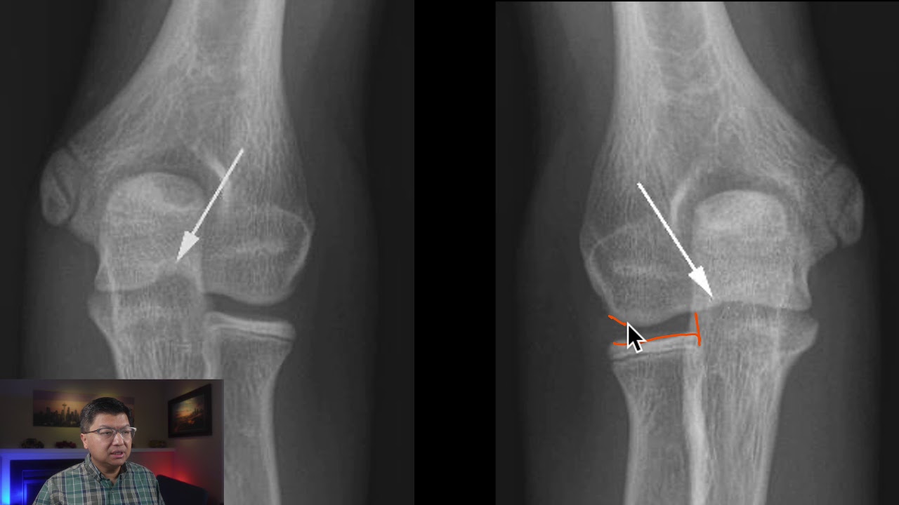 Trochlear OCD
