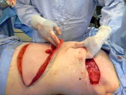 Overview of a 'supercharged' free flap breast reconstruction