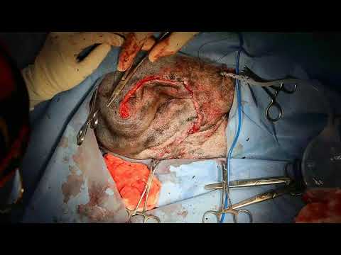 Massive sarcoma with tail axial pattern flap in a dog